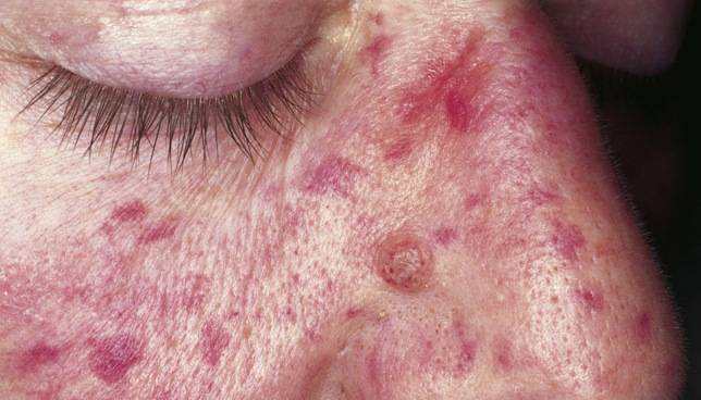 Resultados prometedores de bevacizumab en telangiectasia