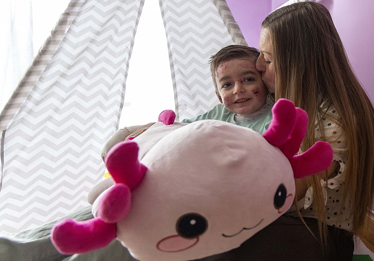 Una «esperanza» para la frágil piel de mariposa
