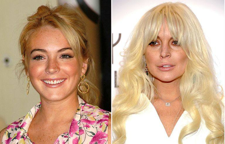 Famosos que como Zac Efron se han desfigurado la cara y ahora se ...