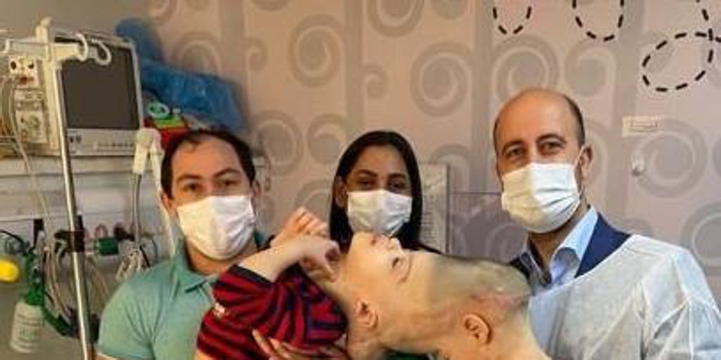 Separan a dos gemelos siameses unidos por el cráneo con ayuda de ...