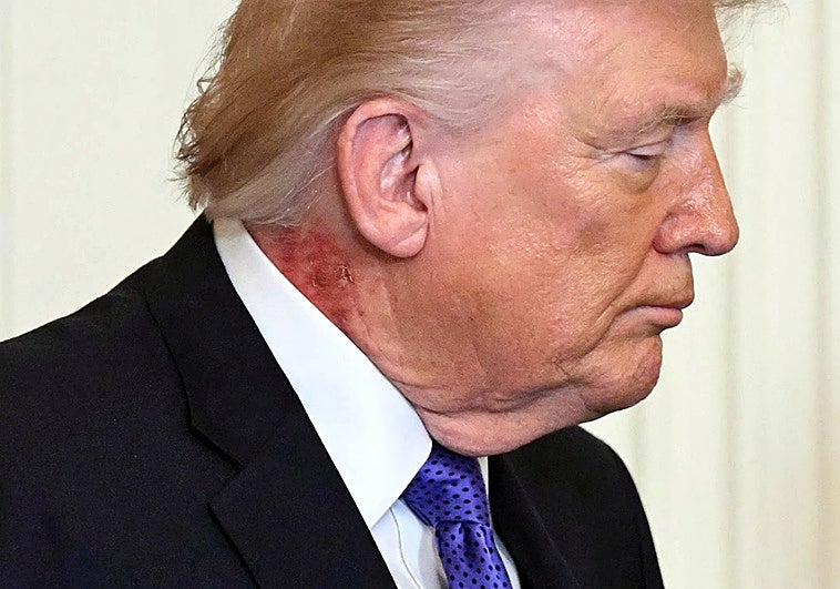 Queratosis actínica, la lesión precancerosa que enrojece el cuello de Trump