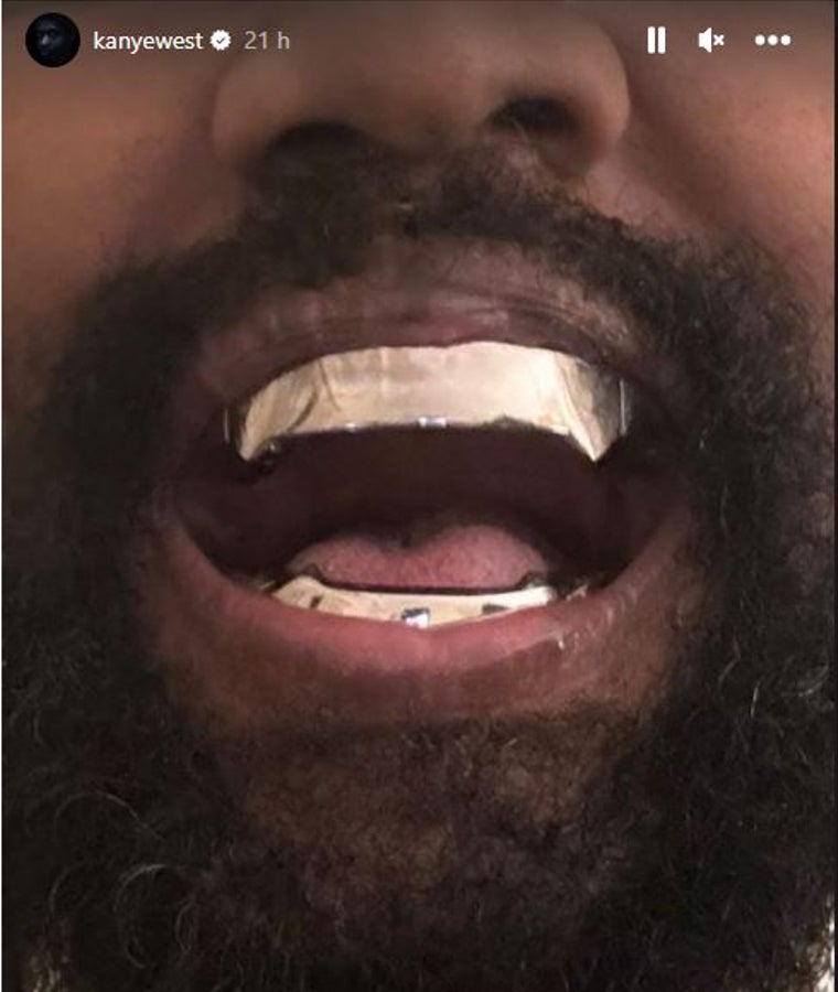 Así Es La Dentadura De Titanio De Casi Un Millón De Dólares Que Se Ha