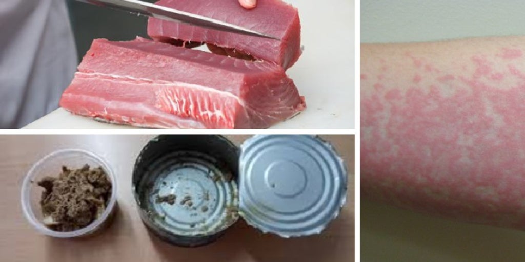 Escombroidosis, la intoxicación alimentaria más común tras tomar atún ...